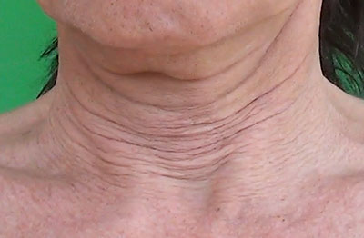 Main skin folds on the human body